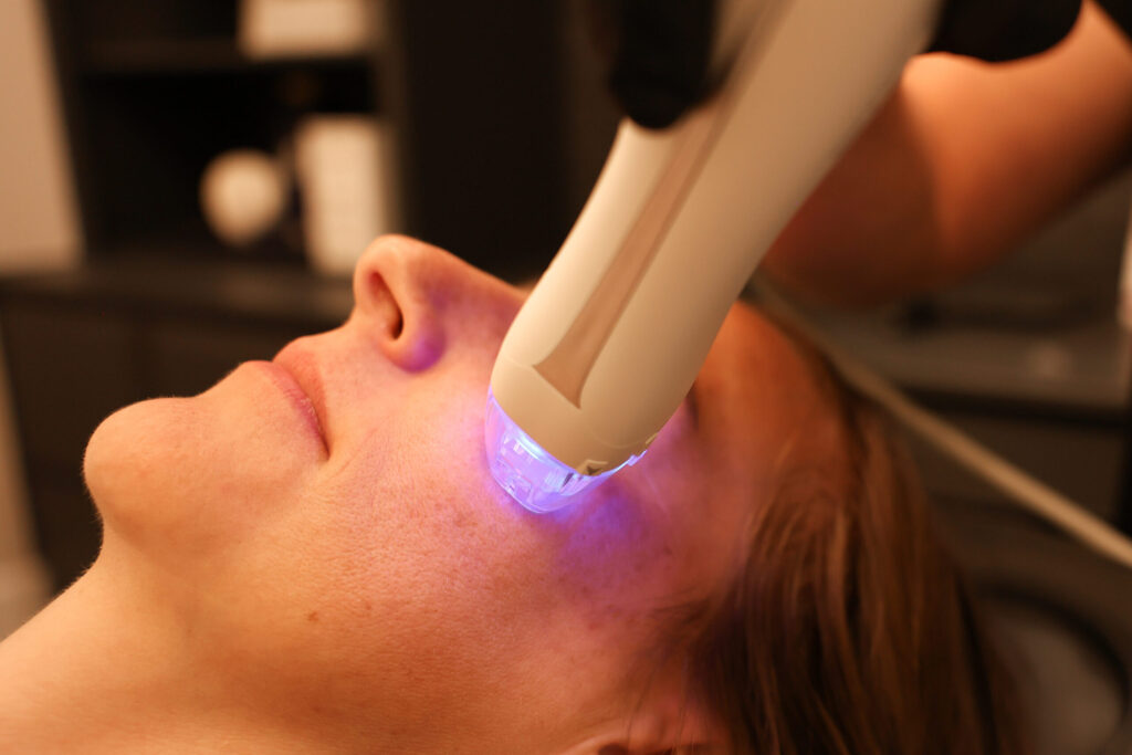 RF Microneedling - Mind and Body Medspa